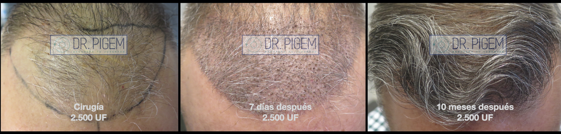 Trasplante capilar SIN rapar - Dr. Pigem
